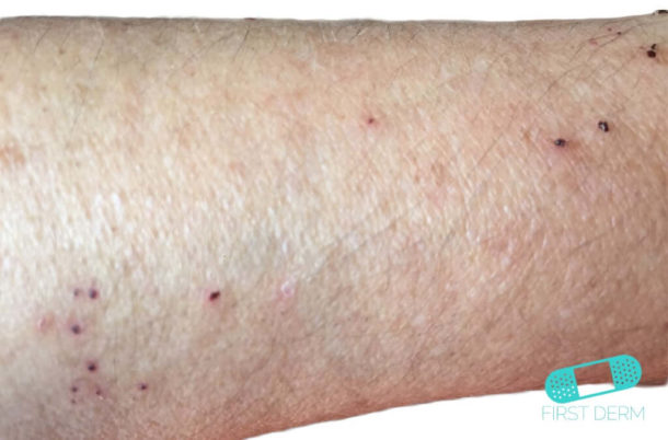 Itchy Red Bumps on Skin – Potential Causes and Treatment