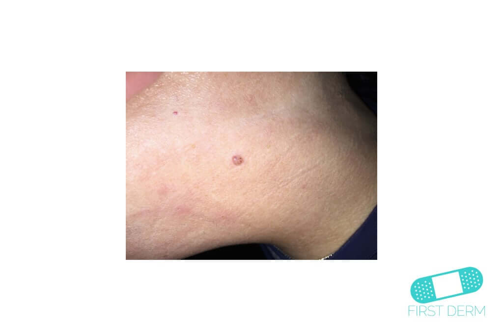 Seborrheic Keratosis (Senile warts) - Online Dermatology