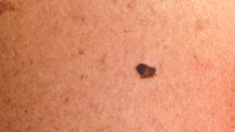 Skin Cancer Pictures, Photos & typical cases - Online Dermatology