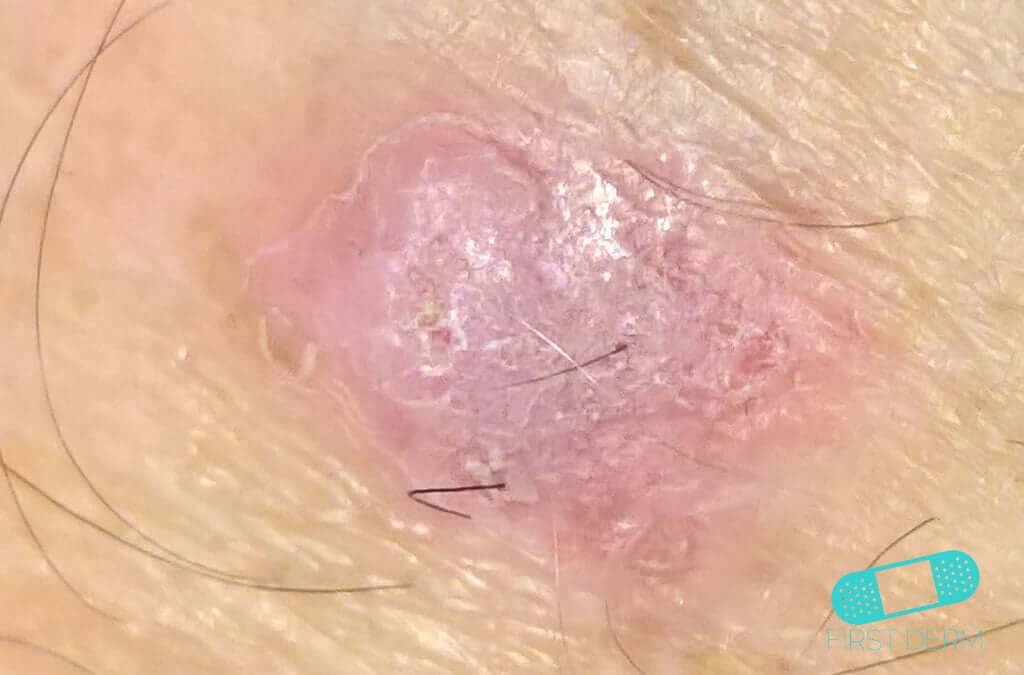 Online Dermatology Squamous Cell Carcinoma online-dermatology-squamous-cell-carcinoma