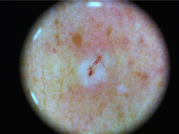 Plattenepithelkarzinom (Spinaliom) – Bilder – Krebsfotos - Dermatology