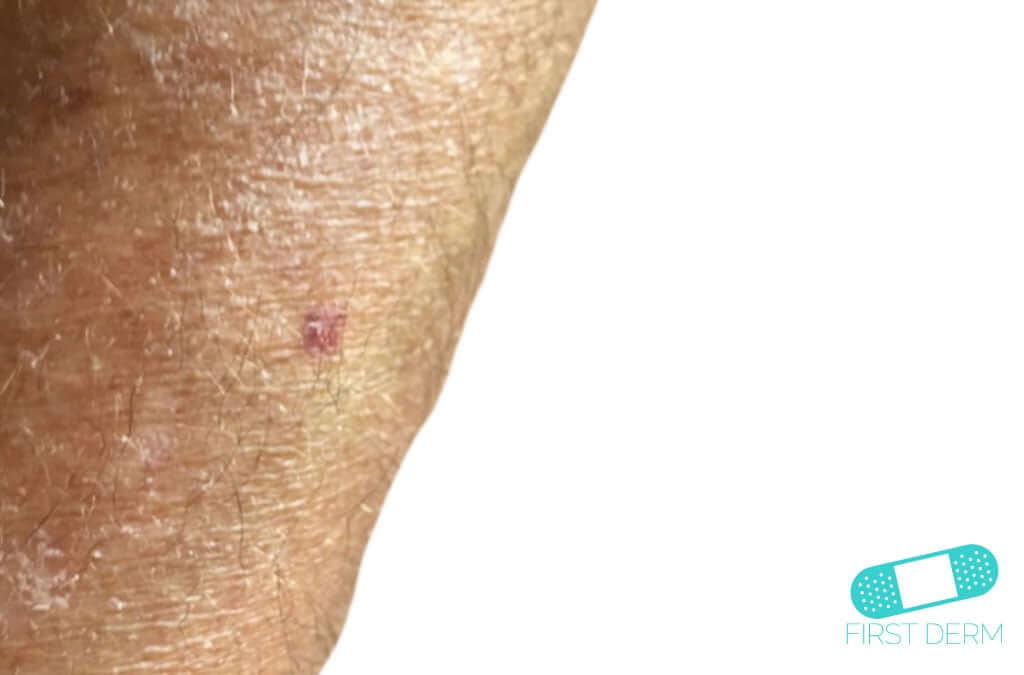 Sun-Damaged Skin - Online Dermatology