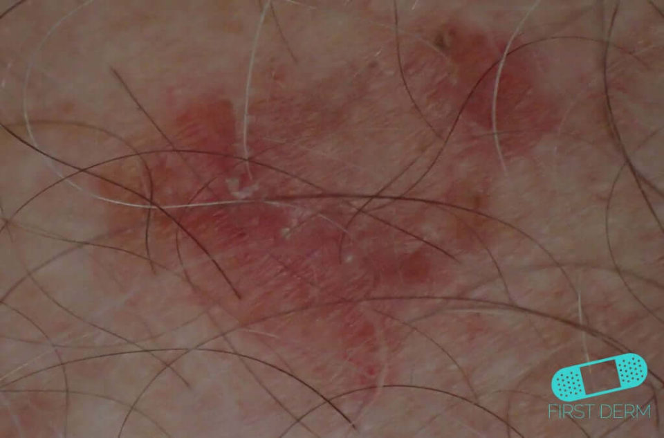 Sun Damaged Skin | First Derm