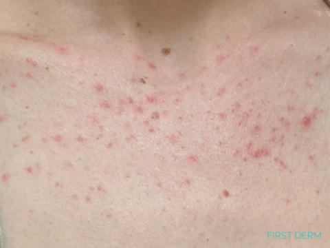 Acne from steroids: Symptoms, causes and what you can do