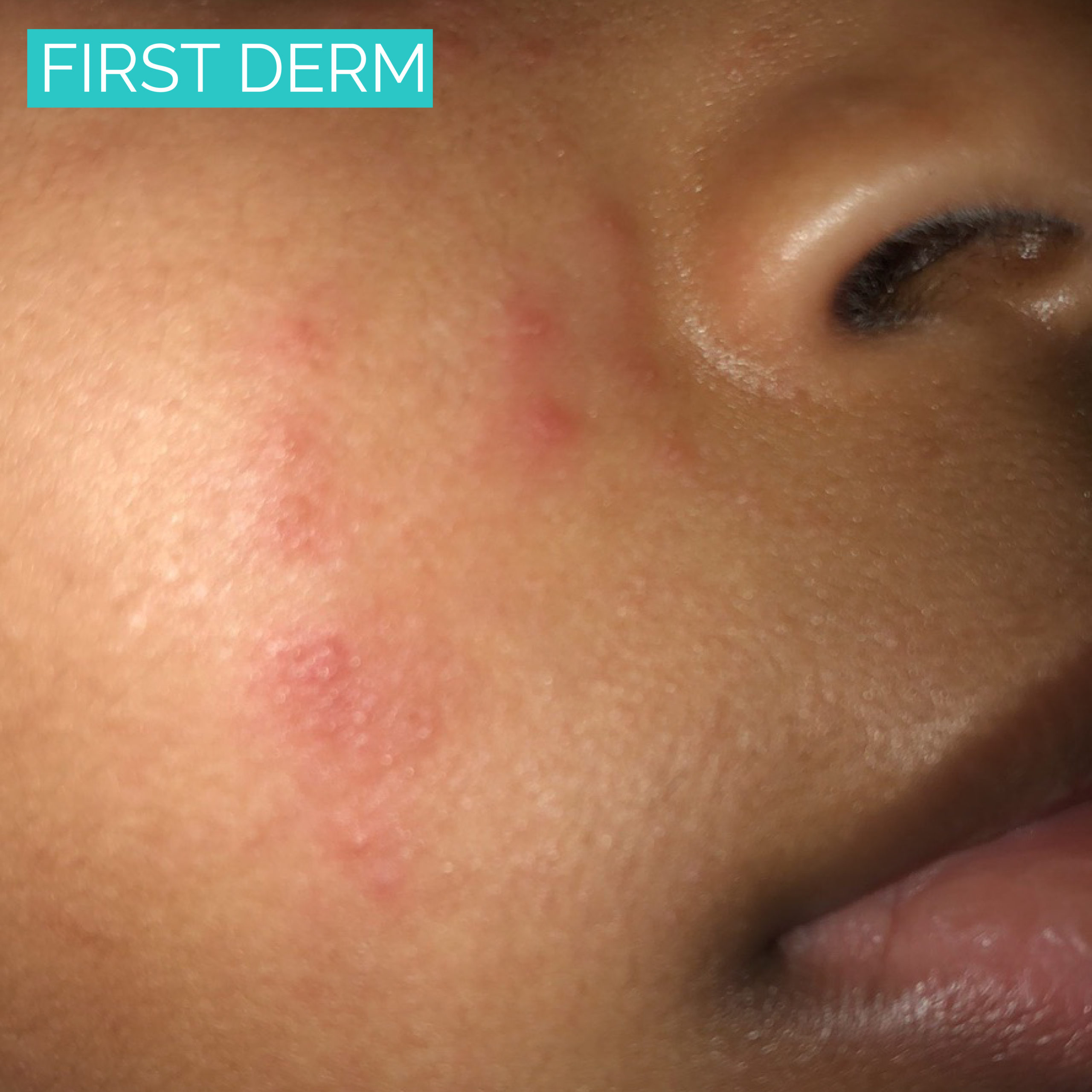 Acne from steroids: Symptoms, causes and what you can do